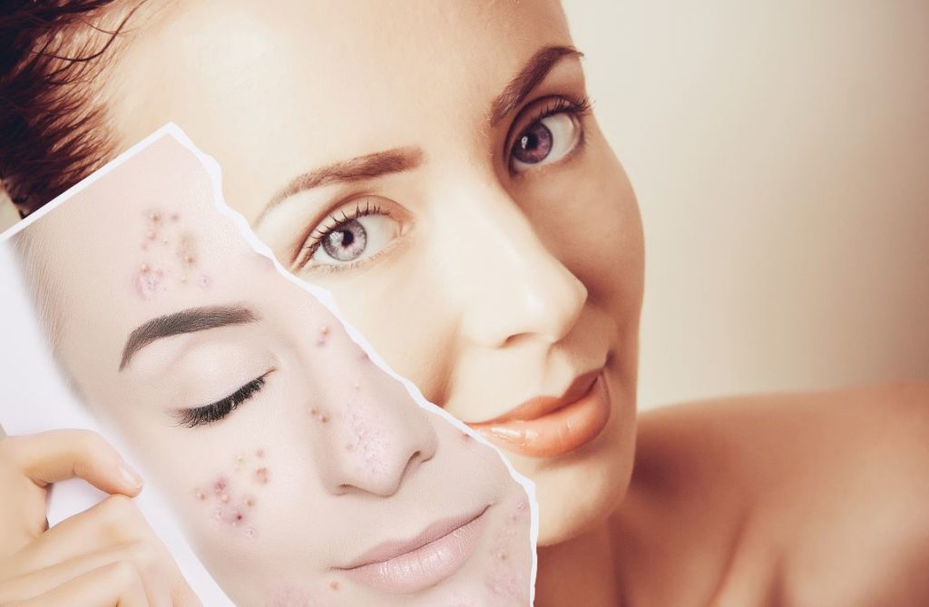 Acné des femmes adultes : nos solutions pour vaincre les boutons